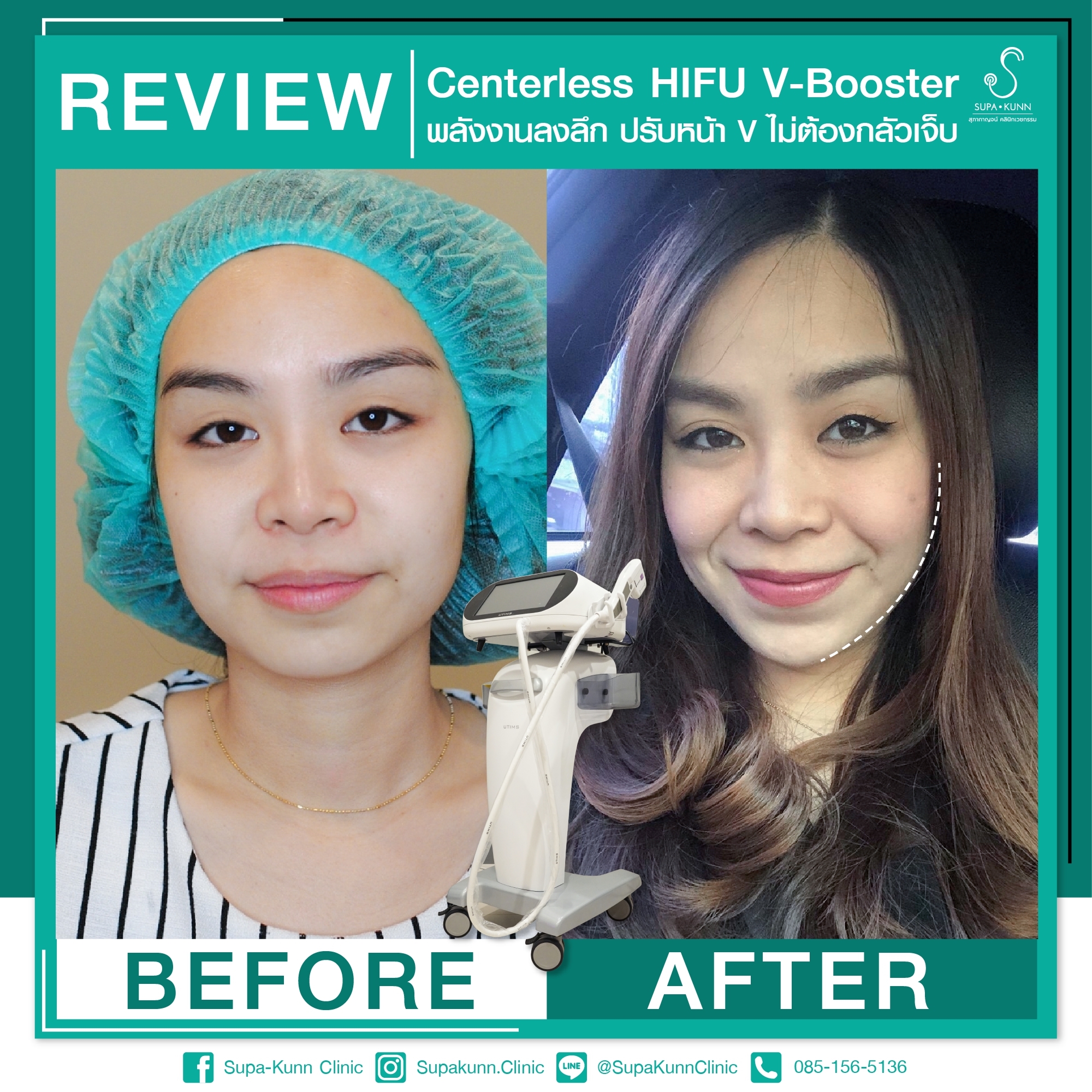 Centerless HIFU V-Booster (UTIMs) - SUPA-KUNN CLINIC