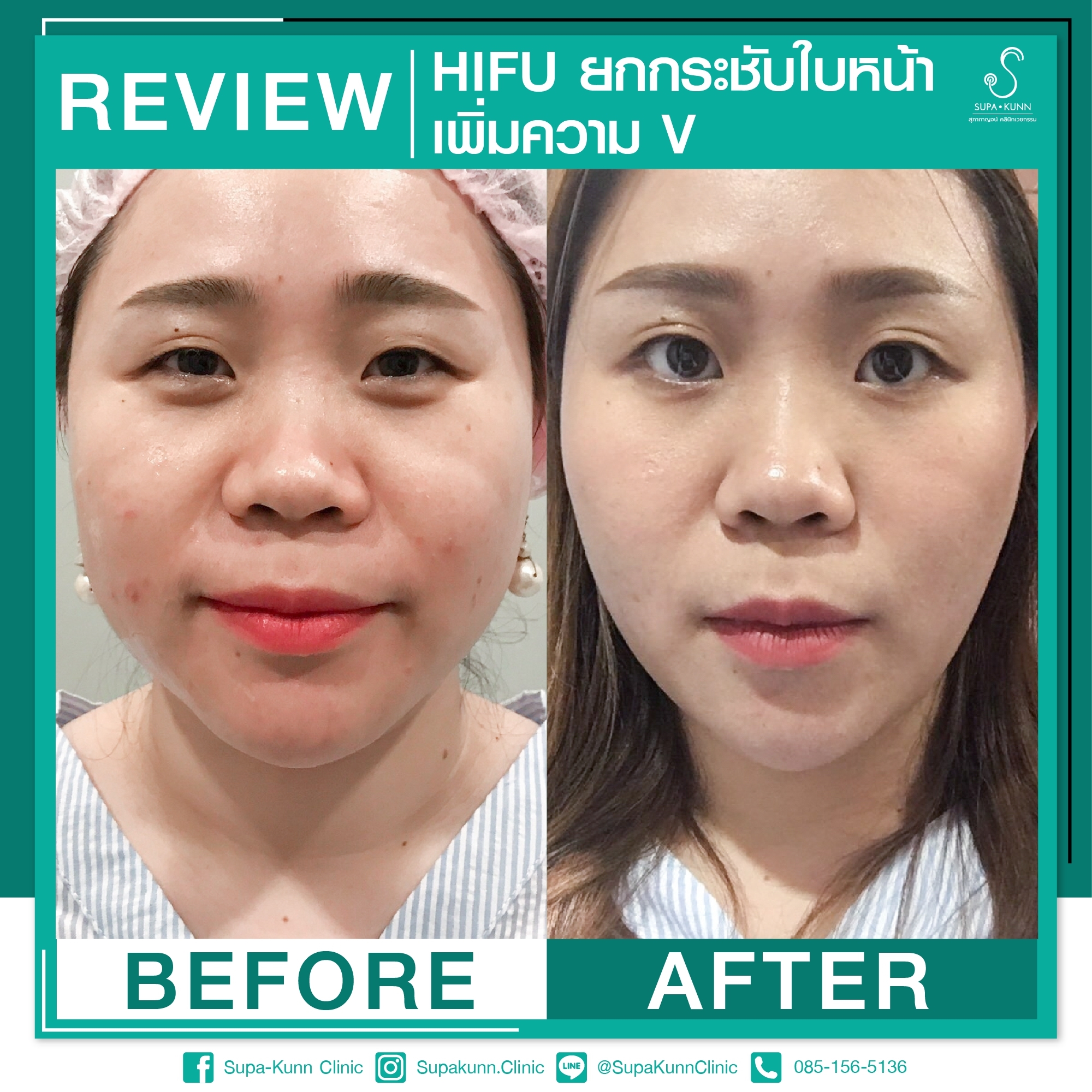 Centerless HIFU V-Booster (UTIMs) - SUPA-KUNN CLINIC